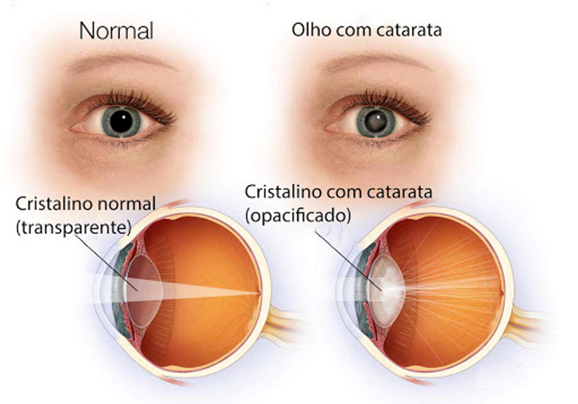 CATARATA – Oftalmoplus